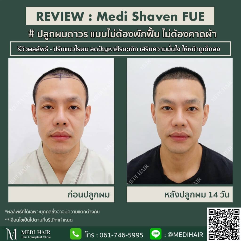 Medi Hair Transplant Clinic