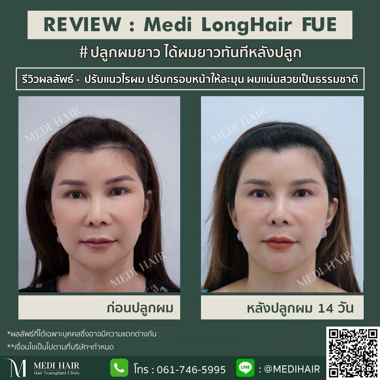 Medi Hair Transplant Clinic